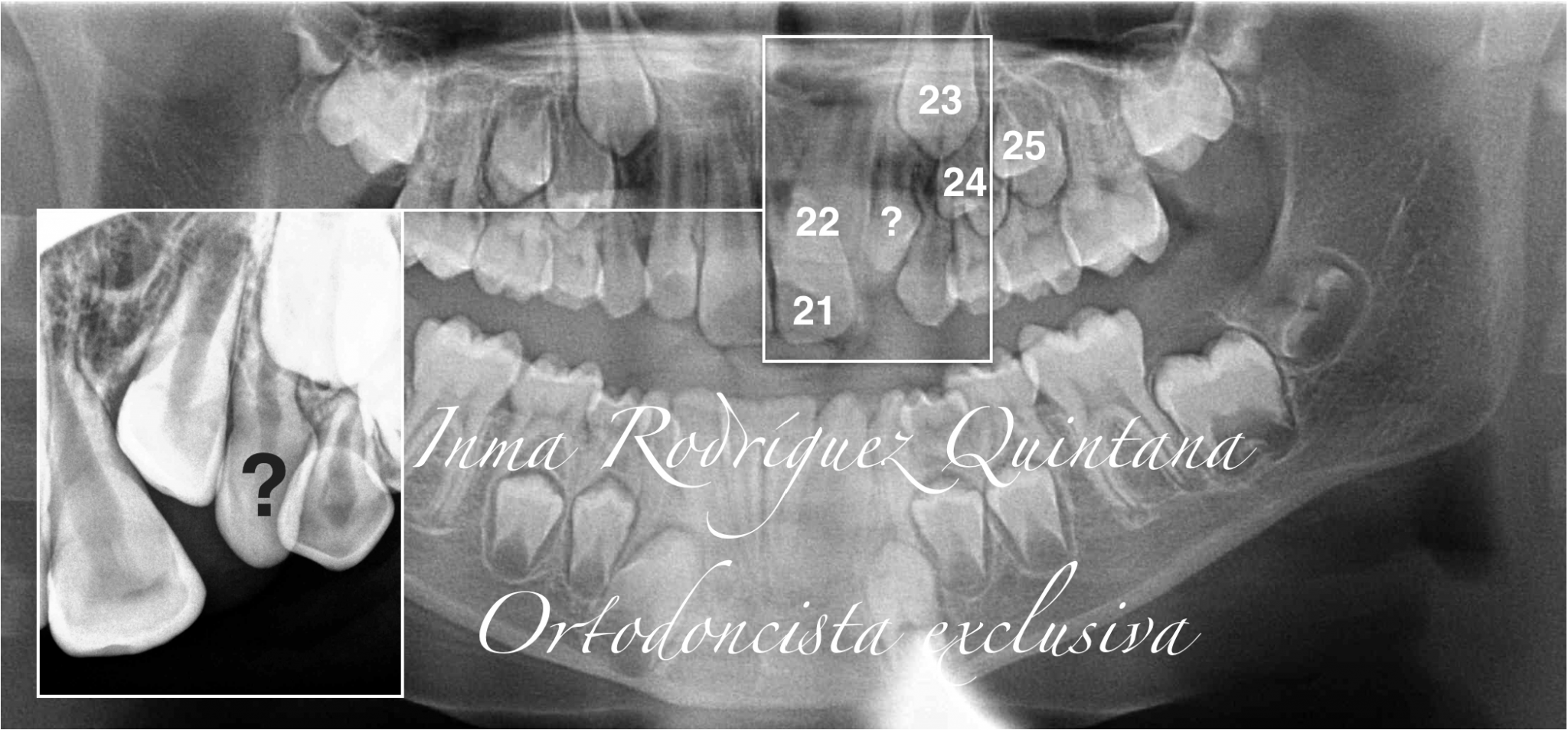 DIENTES SUPERNUMERARIOS, ¿QUÉ SON? - Clínica Dental Pico Blanco