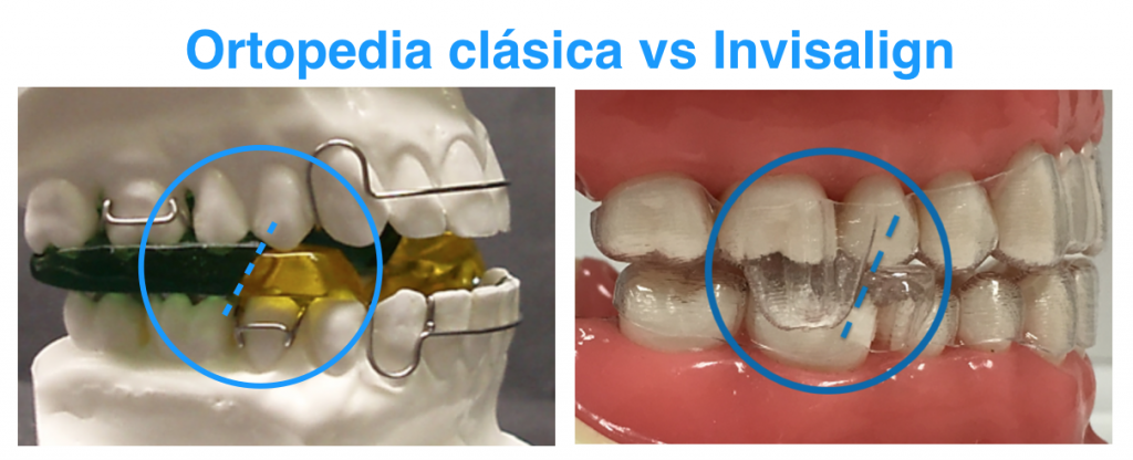 INVISALIGN TEEN ¿ORTODONCIA INVISIBLE EN NIÑOS? - Clínica Dental Pico ...